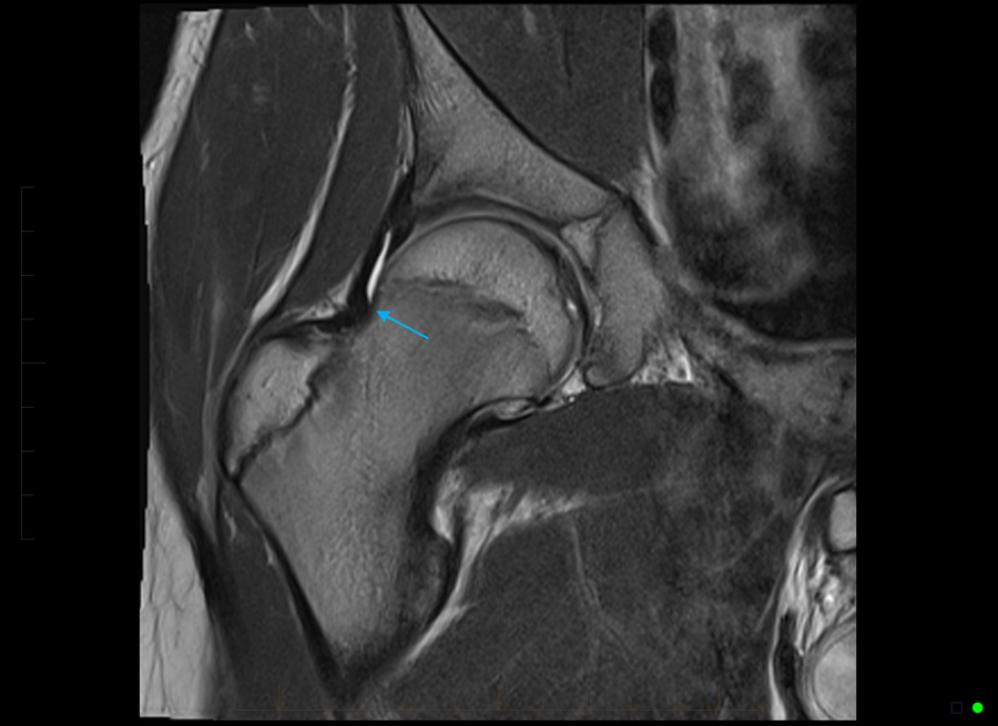 MRI Hip Paediatic MRI Series GP Referred MRI Hip Paediatic MRI Series GP Referred