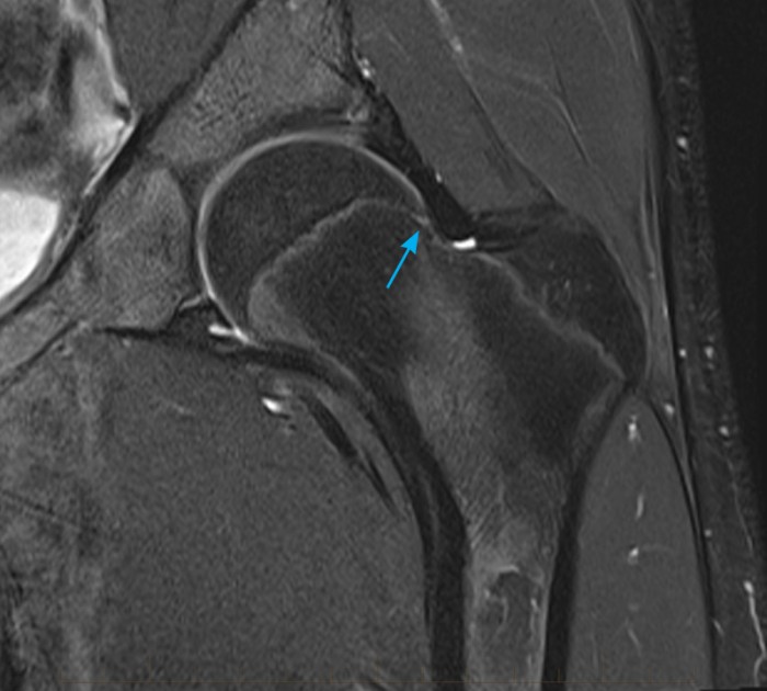Mri Hip Paediatic Mri Series Gp Referred