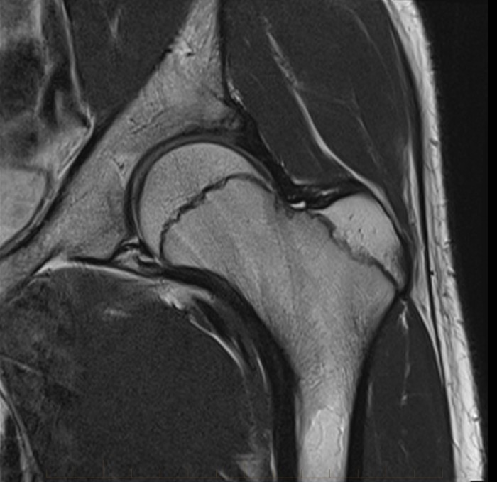 6 fai paediatric mri hip MRI At Melbourne Radiology Clinic 6 fai paediatric mri hip MRI At Melbourne Radiology Clinic