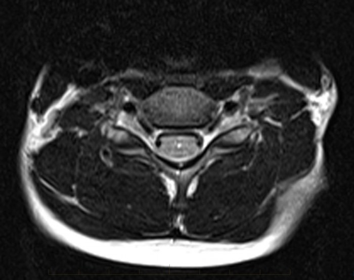 Mri Spine Paediatic Mri Series