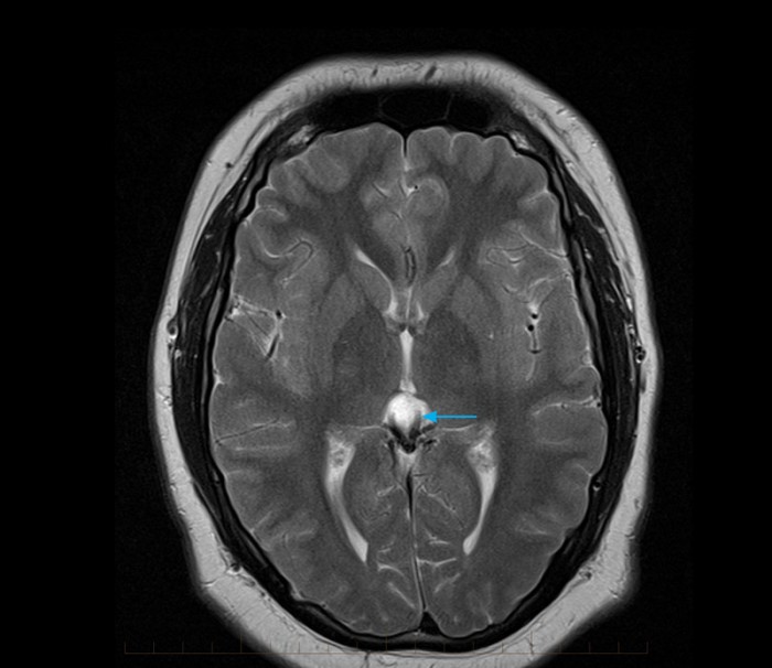 MRI of Paediatric Brain - demonstrates presence of a benign simple cyst ... MRI of Paediatric Brain - demonstrates presence of a benign simple cyst ...