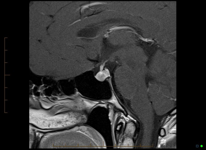 Brain with contrast showing normal enhancement of the pituitary gland ...