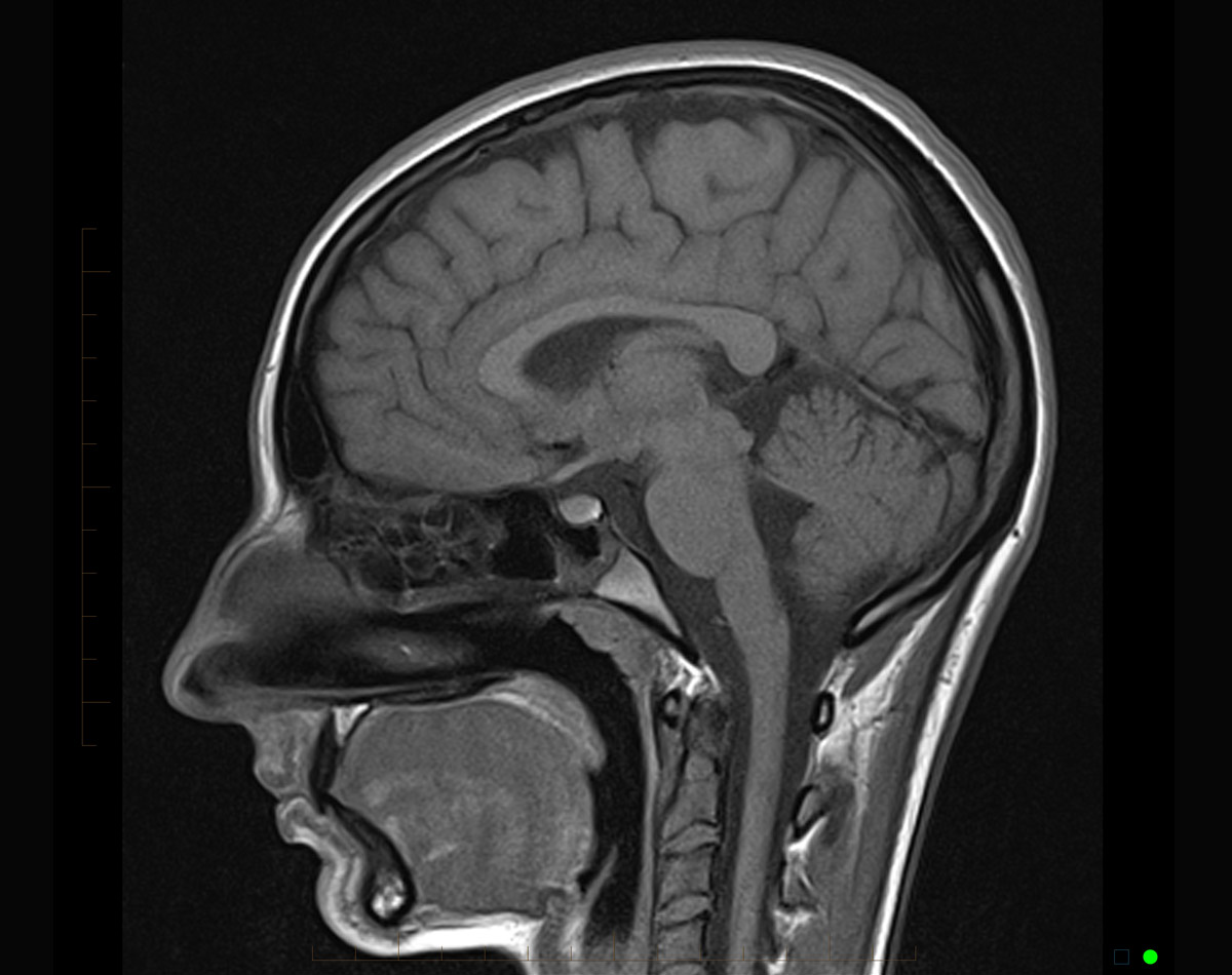 mri-brain-scan-child-brain-melbourne-radiology - MRI at Melbourne ... mri-brain-scan-child-brain-melbourne-radiology - MRI at Melbourne ...