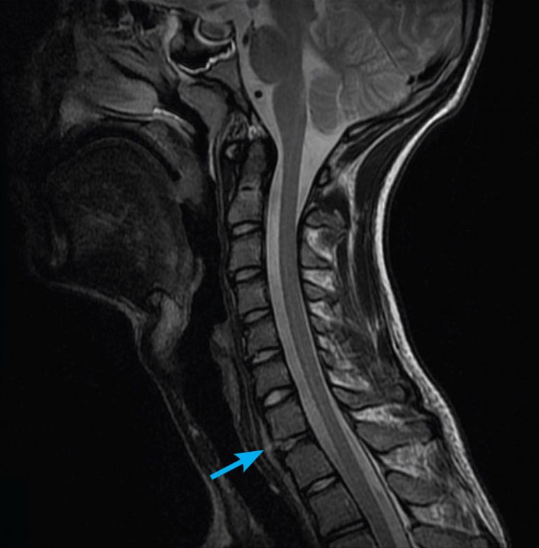 Cervical Spine Mri Procedure Cervical Spine Mri Procedure