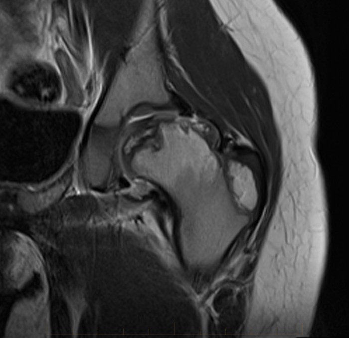 7-perthes-disease-paediatric-mri-hip - MRI at Melbourne Radiology Clinic