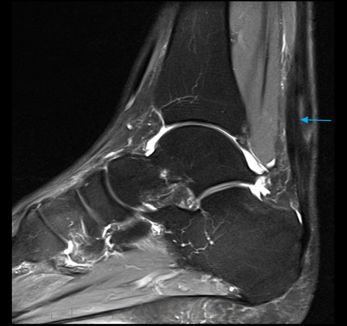 MRI Achilles Tendon - Melbourne Radiology