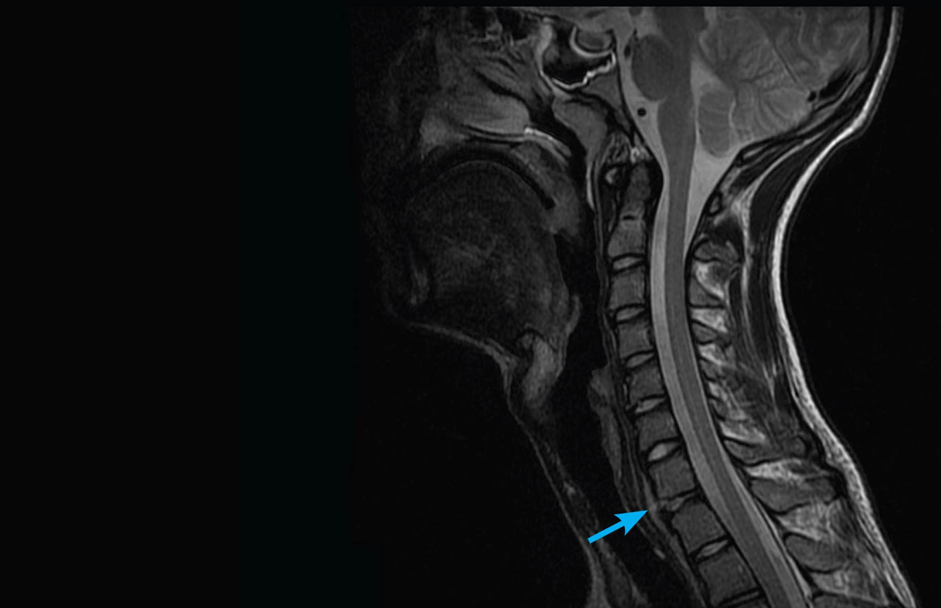 mri-scan-spine-melbourne-radiology-clinic-2 - MRI at Melbourne ...